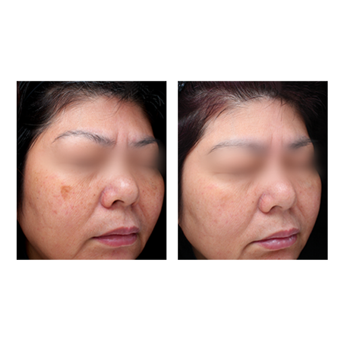 Q-Switched Laser Technology