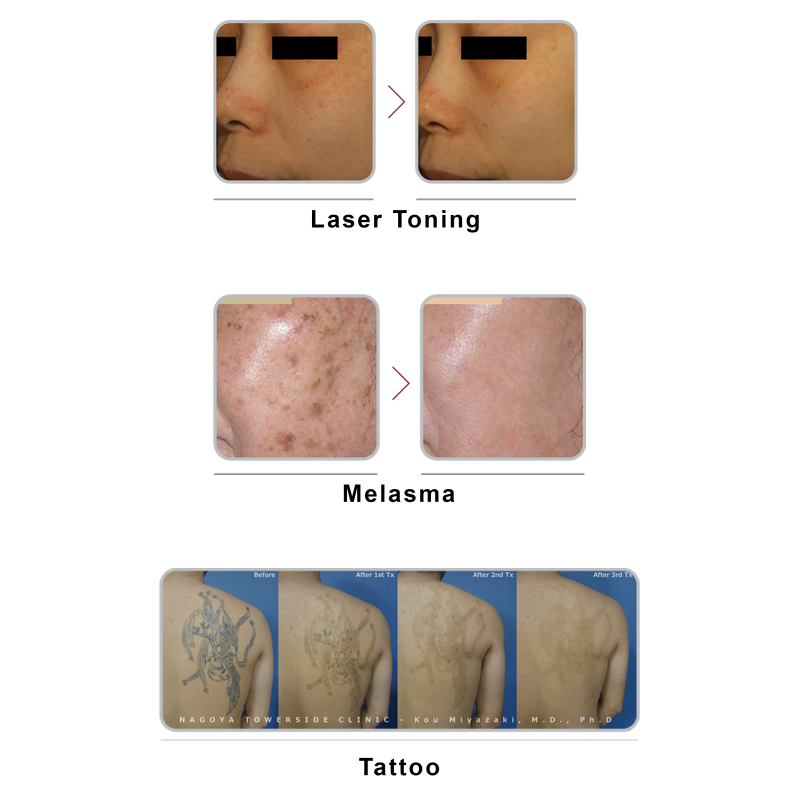 TRI-BEAM Premium - Creative Skin